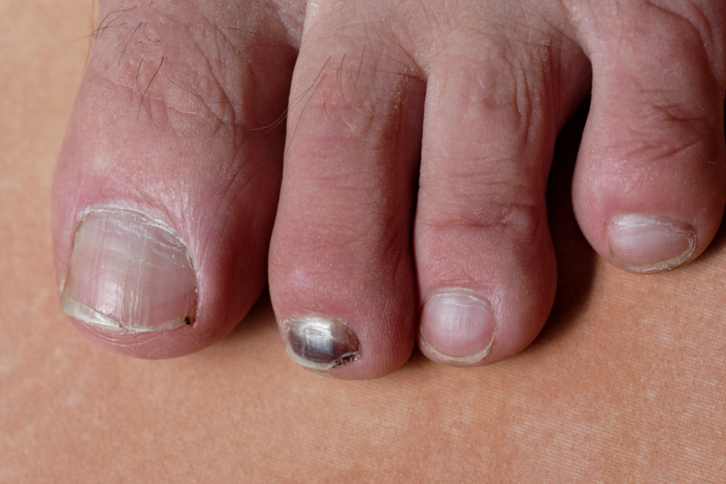 Causes of Black Toenails | Sierra Foot & Ankle